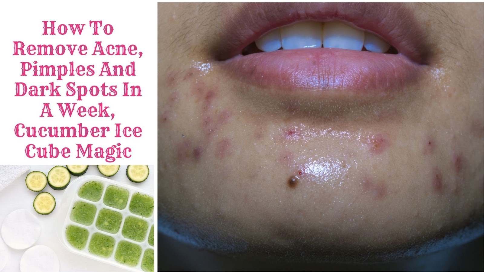 How To Remove Acne Pimples And Dark Spots In A Week Cucumber Ice Cube how-to-remove-acne-pimples-and-dark-spots-in-a-week-cucumber-ice-cube