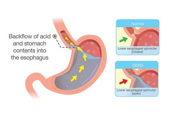 Gastroesophageal reflux disease (GERD): Know the condition & Lifestyle ...