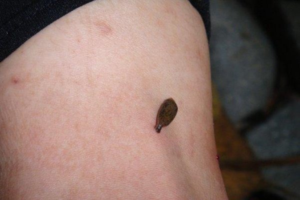 Akyatera Bundokera: Bloody Hell! : Limatik Encounters