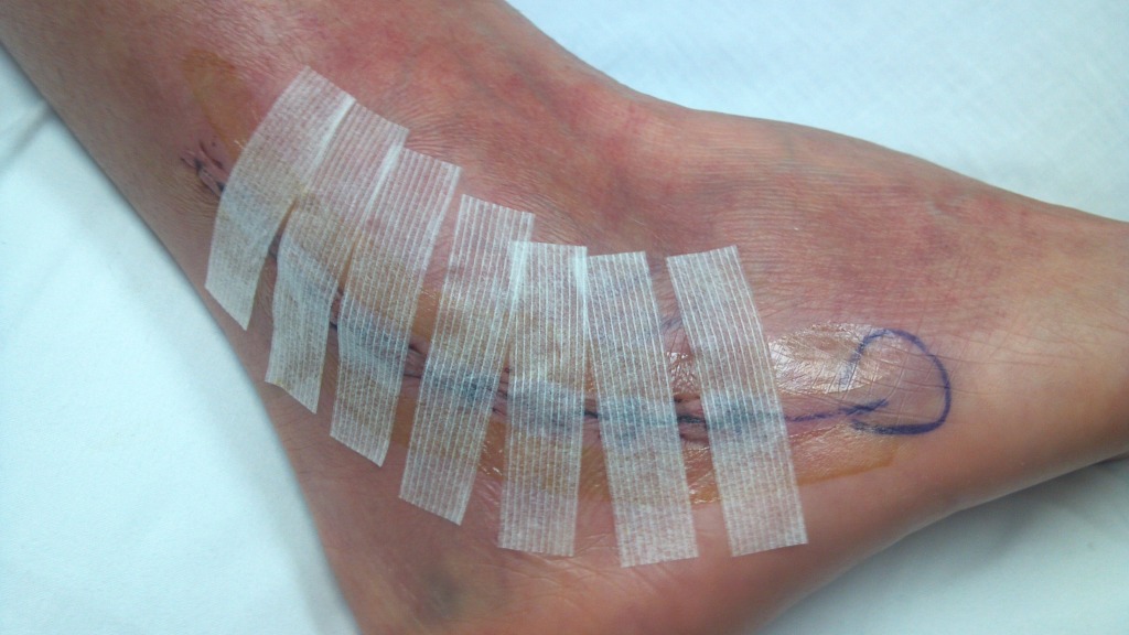 Chris' peroneal tendon surgery: Recovery