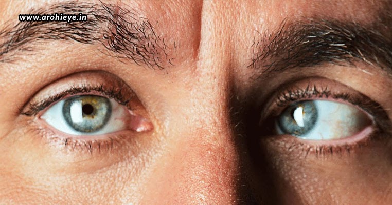 Arohi Eye Hospital - Best Eye Care Hospital in Oshiwara Mumbai: Squint ...