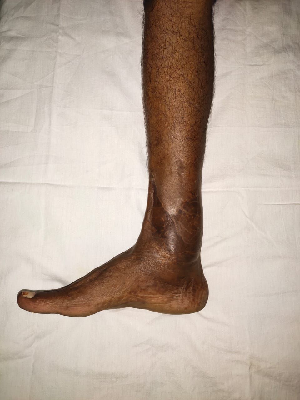 OPEN ANKLE JOINT FRACTURE DISLOCATION - DEBRIDEMENT - FREE GRACILIS ...