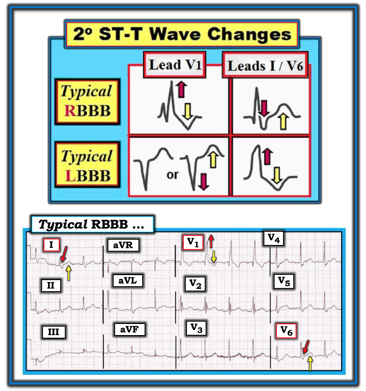 Dr. Smith's ECG Blog: Two patients with RBBB