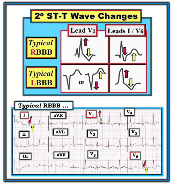Dr. Smith's ECG Blog: Two patients with RBBB
