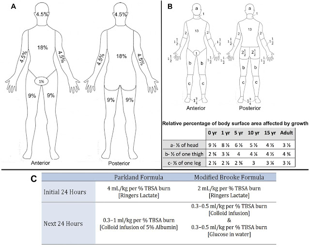 White Tower・White Jungle: [外科筆記] 燒燙傷 Burn・輸液給予 Fluid Resuscitation