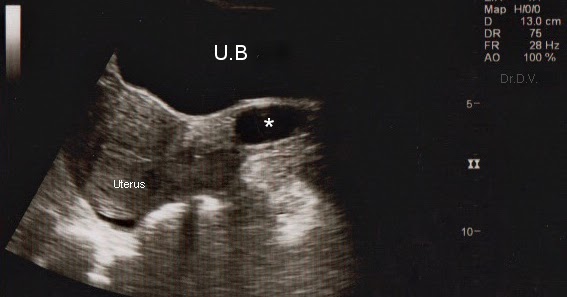 Wolffian Duct Cyst