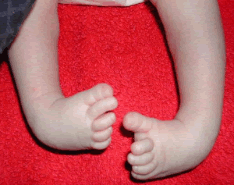 VittoriFootAnkleSpecialist: Clubfoot