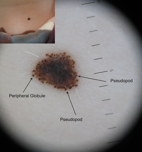 Dermoscopy Features as Clues: Black dots or clods peripheral
