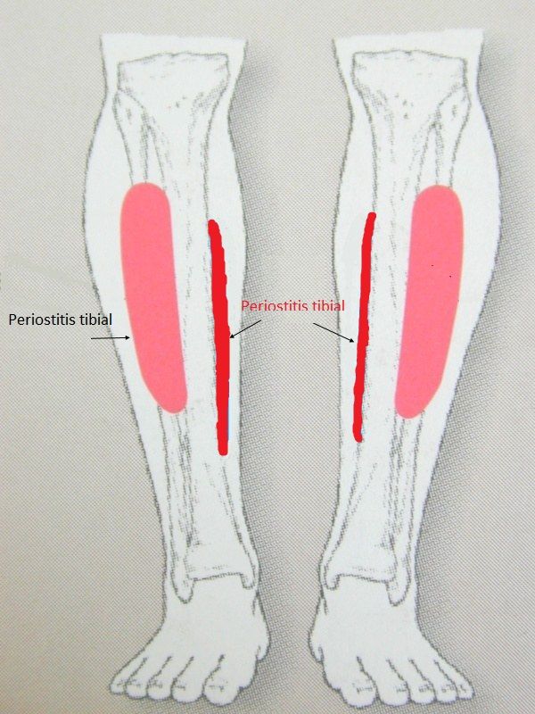 A mis cuarenta y...: Lesiones: La Periostitis Tibial