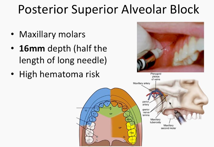 WEBINAR: Local Anesthetics - Injections and Techniques
