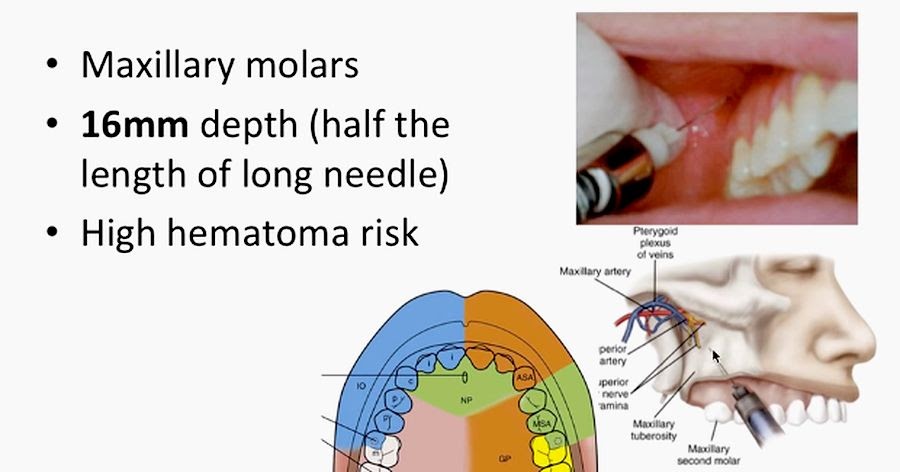 WEBINAR: Local Anesthetics - Injections and Techniques - Odonto-Tv