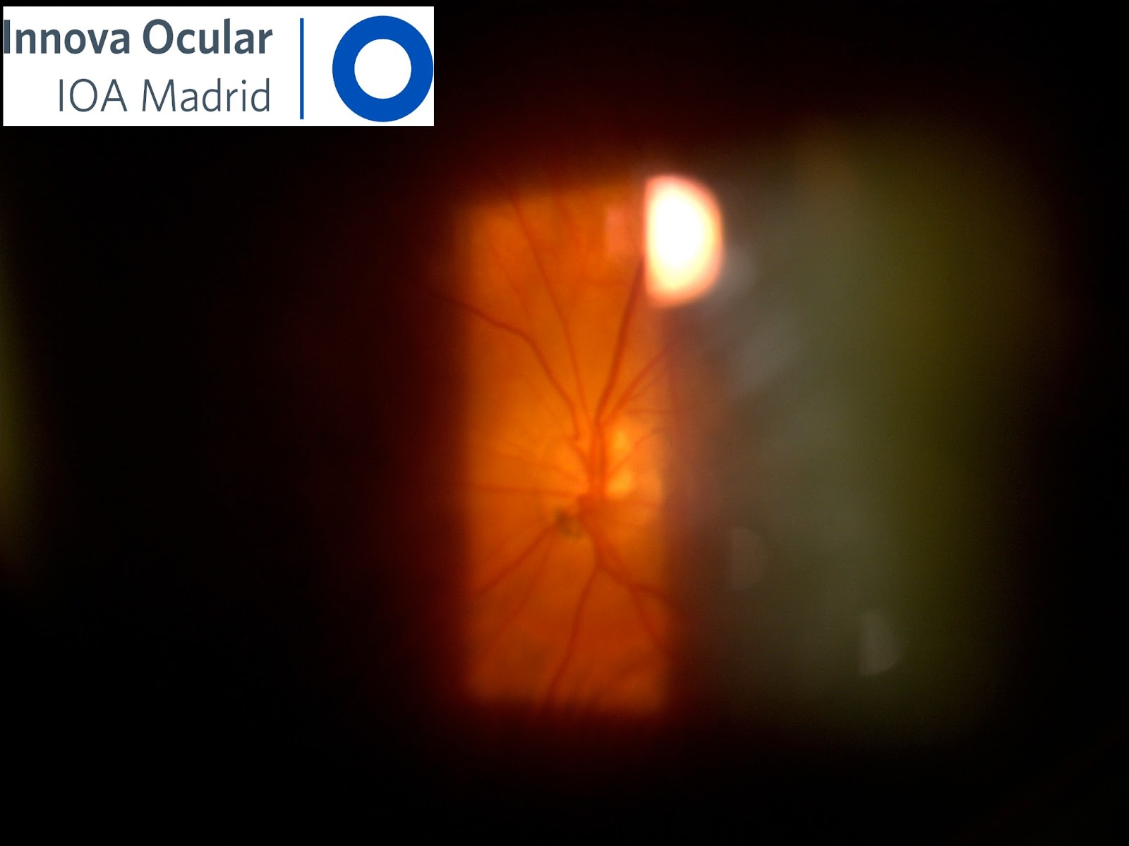 Miranza IOA: MICROFTALMIA