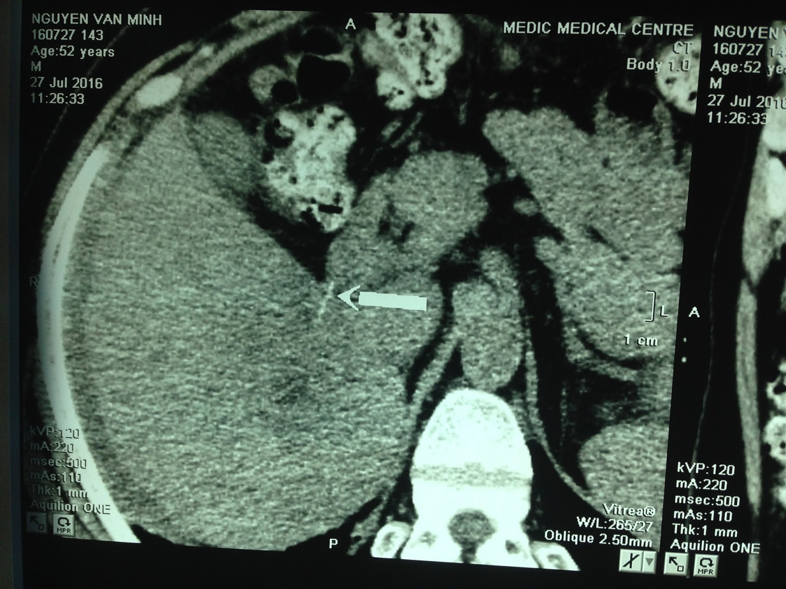VIETNAMESE MEDIC ULTRASOUND: CASE 387: LIVER ABSCESS DUE TO FISHBONE ...