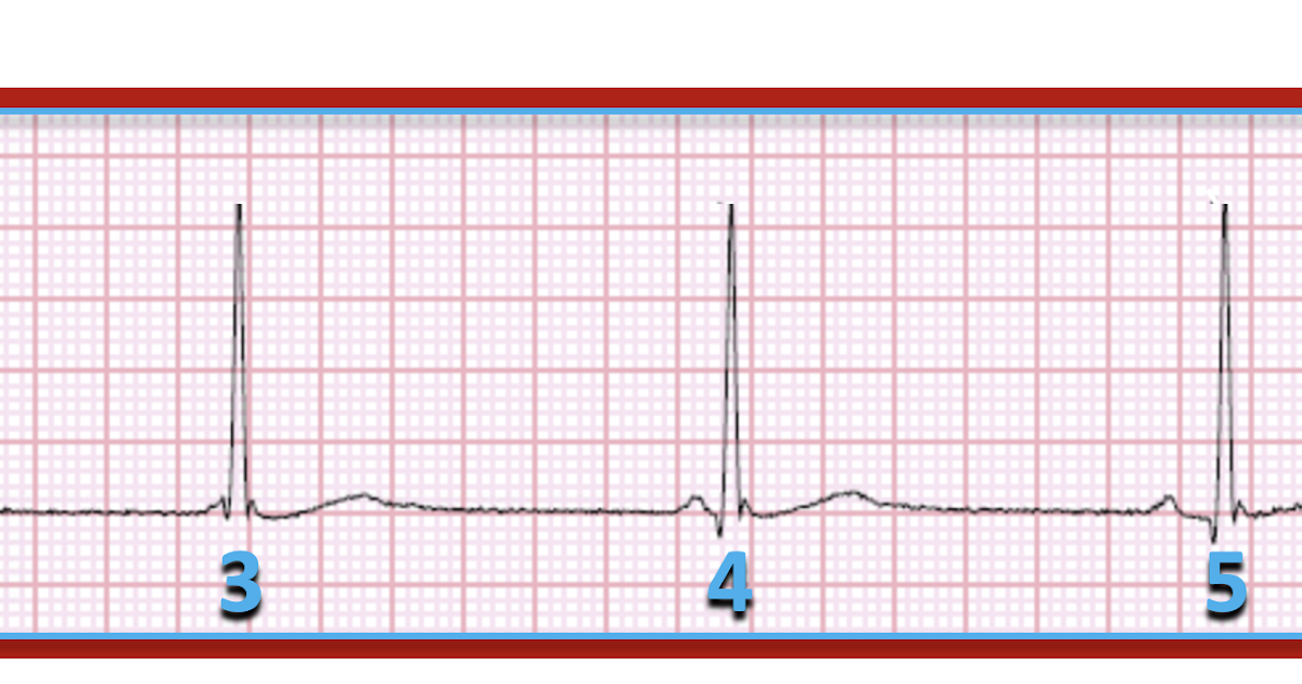 ECG Interpretation: ECG Blog #192 (ECG MP-9) — AV Dissociation by ...