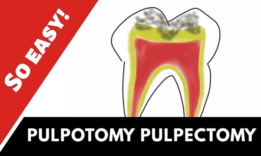 Pulpotomy