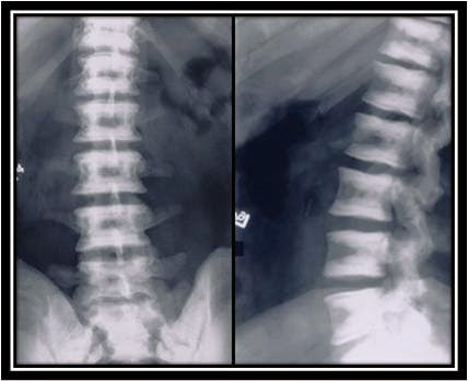 RADIOLOGY IMAGE SPOTTERS: Osteopetrosis