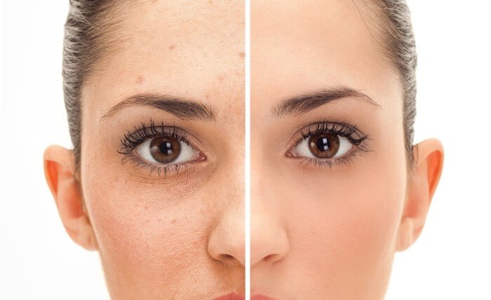 Como Sacar Los Granos Rapidamente - Tratamiento Para El Acne Natural y ...