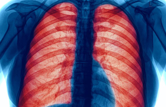 MedFriendly Medical Blog How To Naturally Treat COPD medfriendly-medical-blog-how-to-naturally-treat-copd