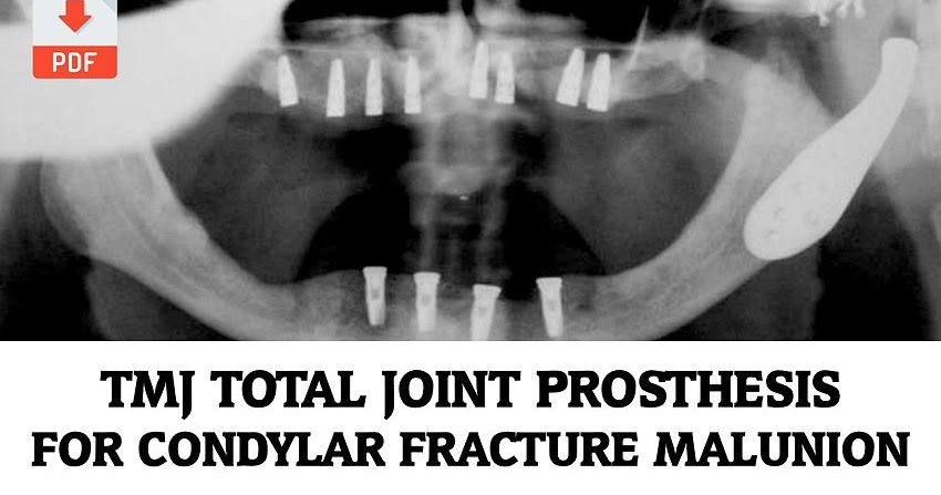 PDF: TMJ Total Joint Prosthesis for Condylar Fracture Malunion - Ovi Dental