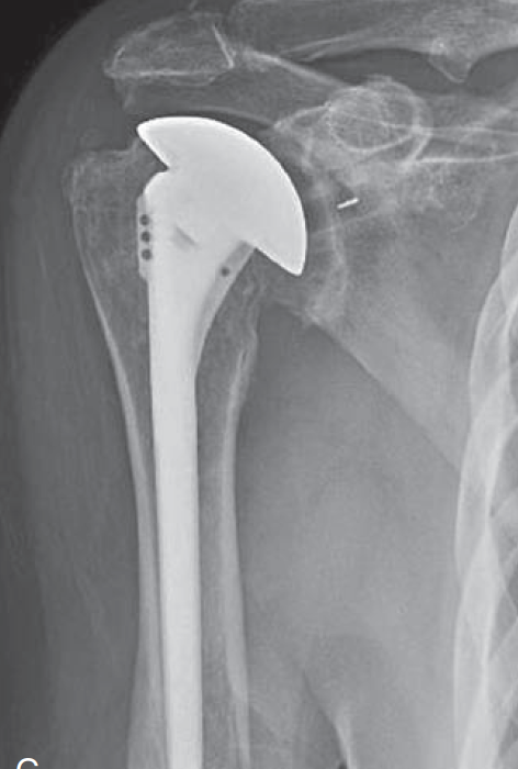 UW Shoulder and Elbow Academy: The importance of the humeral osteotomy ...