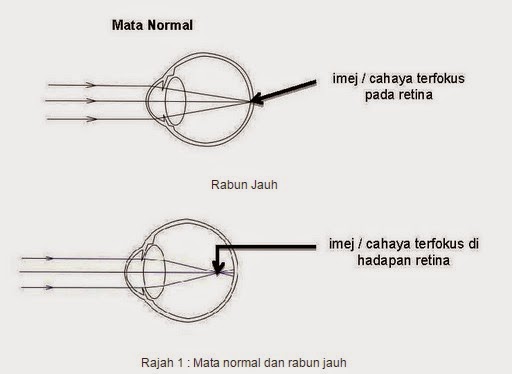 Lagenda Optometrist: RABUN JAUH- PART 1
