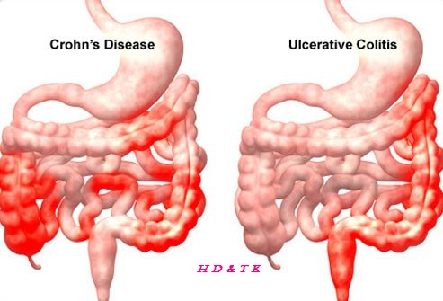 Crohn's Disease