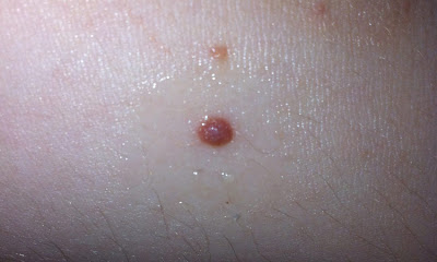 How to Remove a Mole with Apple Cider Vinegar: Day 1: Removing A Mole ...