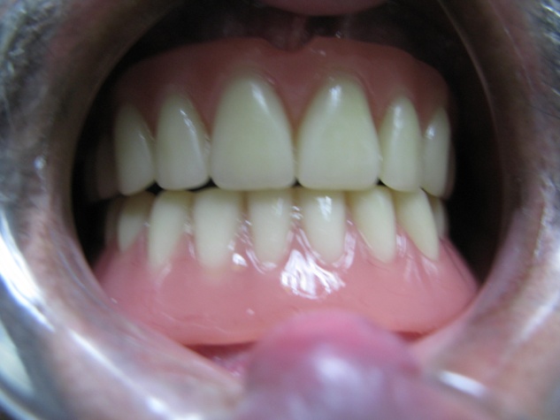 Casos clínicos - AriadneHerrera.: Paciente desdentado rehabilitado con ...