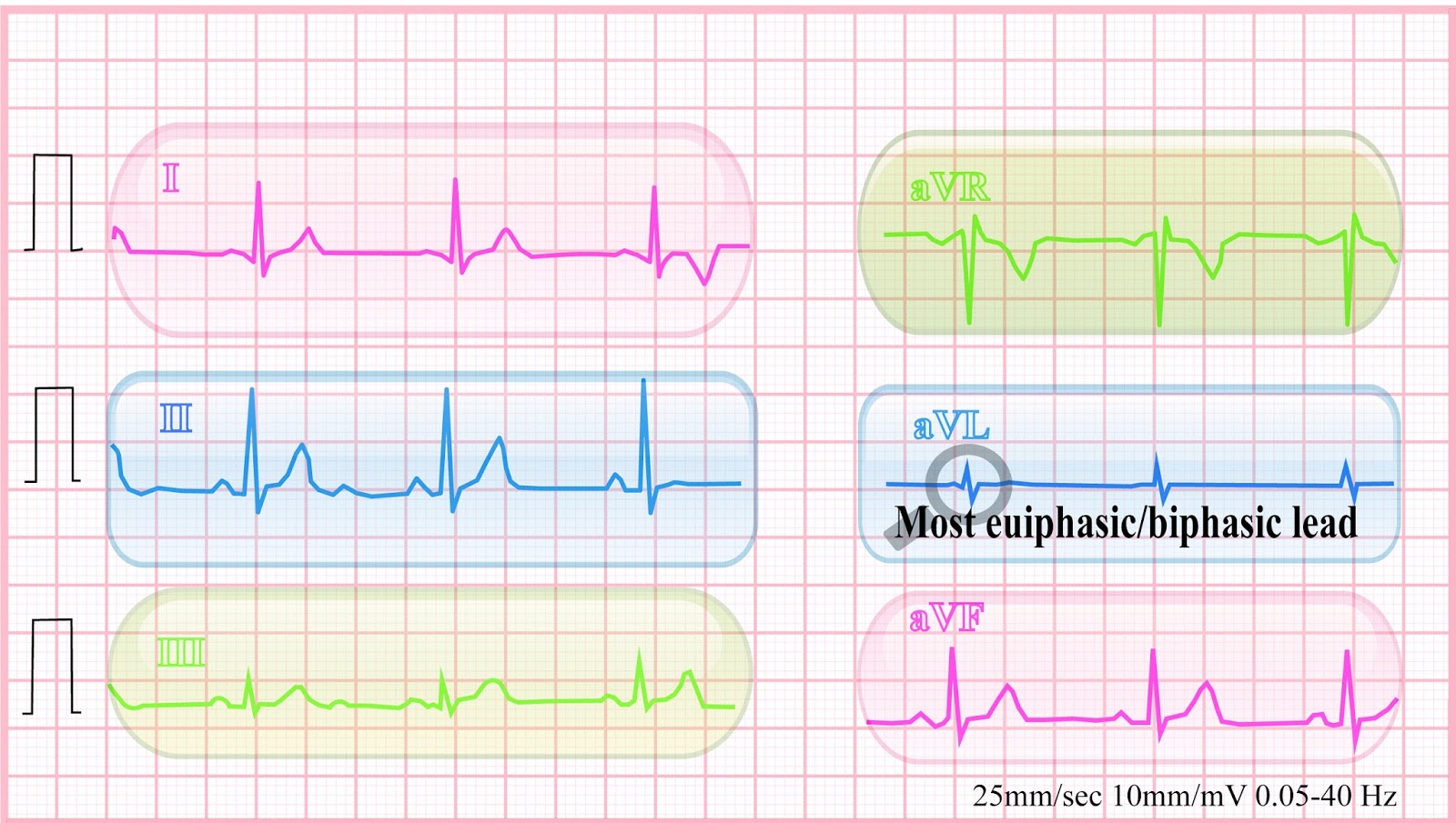 ECG Educator Blog : Cardiac Axis Made Easy