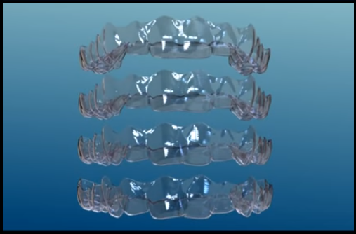 Invisalign : Nouvel appareil dentaire transparent