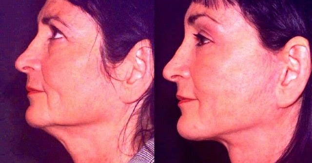 A Facial Exercise Toning Program That Results In Natural Facelifts ...