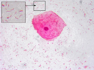 Fun With Microbiology (What's Buggin' You?): Bacterial Vaginosis