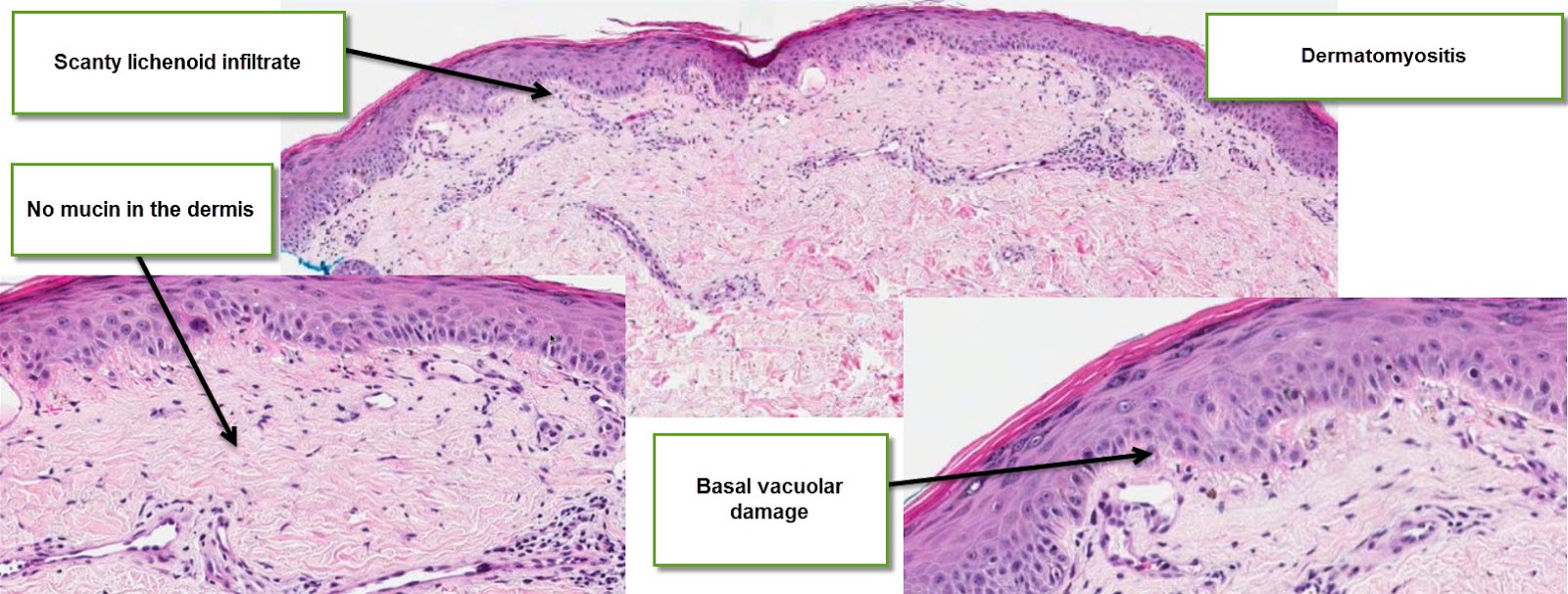 Dermatopathology Made Simple - Inflammatory: Interface - Vacuolar ...