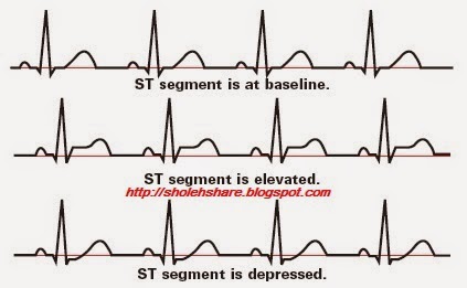 ST Elevasi Miokard Infark (STEMI) pada EKG | SholehShare