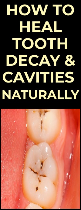 Heal Tooth Decay & Cavities Naturally With 3 Simple And Effective Home ...