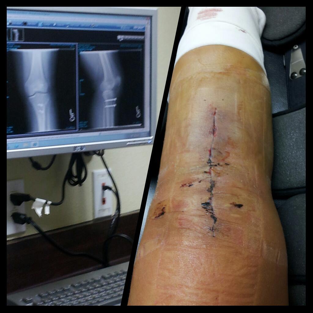 My Journey: ACI Surgery Recovery