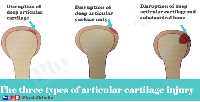 Articular cartilage injury ,Common sites injury,Treatment of articular ...