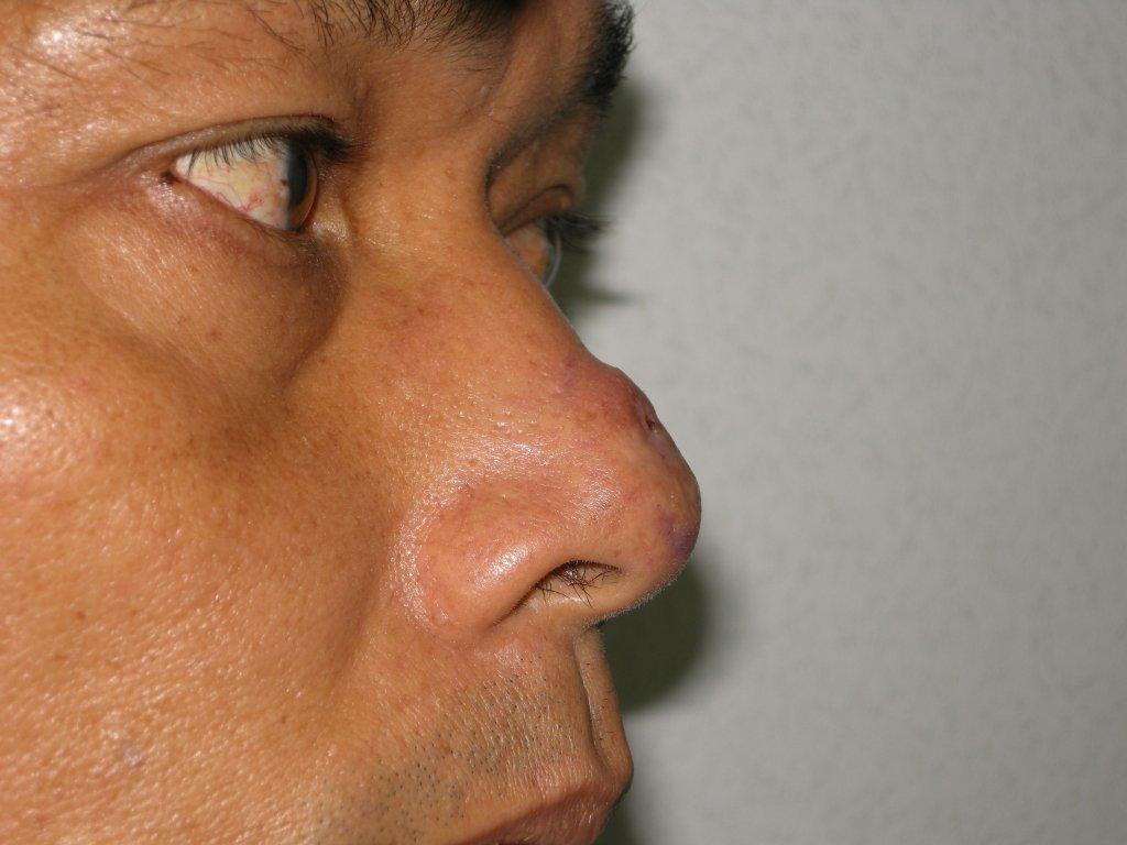 VIRTUAL GRAND ROUNDS IN DERMATOLOGY 2.0: Nasal Tumor for Diagnosis