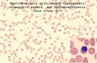 Case study (17)- Myelodysplasia with severe hypochromic, normocytic ...