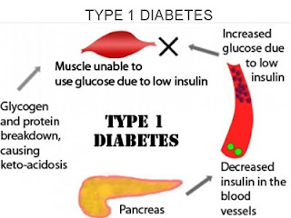Reviews: Type 1 diabetes and risk factors to cause diseases