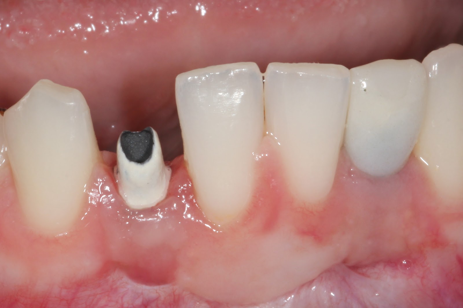 Boise Idaho Prosthodontics: Nobel Active 3 mm Custom Abutment Emax ...