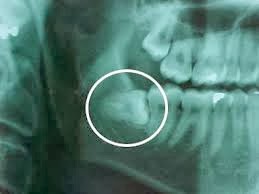 Mis brackets :D: Colocacion de brackets y Extraccion de muelas del juicio