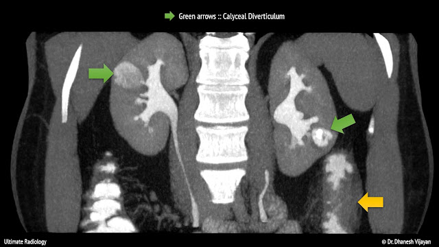 Ultimate Radiology : Calyceal Diverticulum