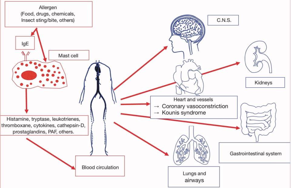ZONA DE SALUD DE OFRA: Ann Transl Med. Síndrome de Kounis.