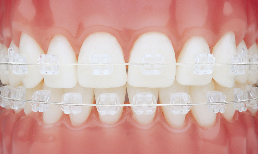 Dentistas, Ortodontia em Petropolis: Aparelho Estético