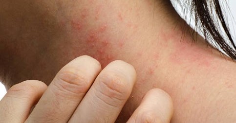 8 Best Essential Oils for Heat Rash: Quick Natural Remedies - Health ...