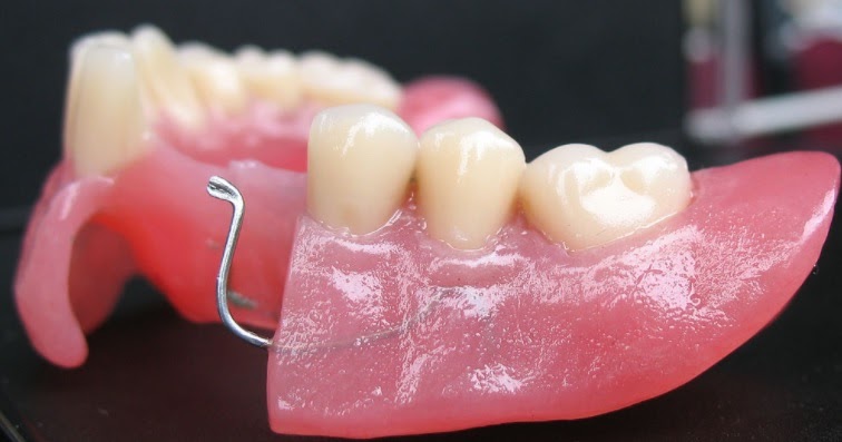 PROTESIS PROVISIONALES