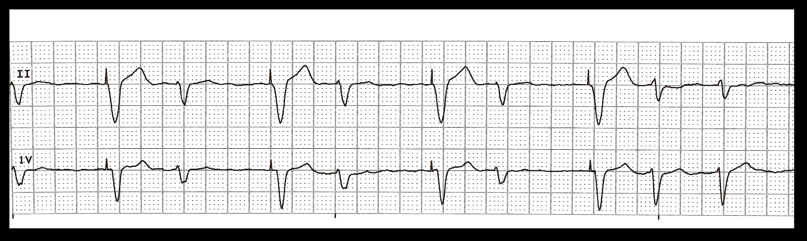 Float Nurse: Basic EKG Rhythm Test 20