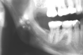 TONSILOLITÍASE - O QUE É ISSO DOUTOR?