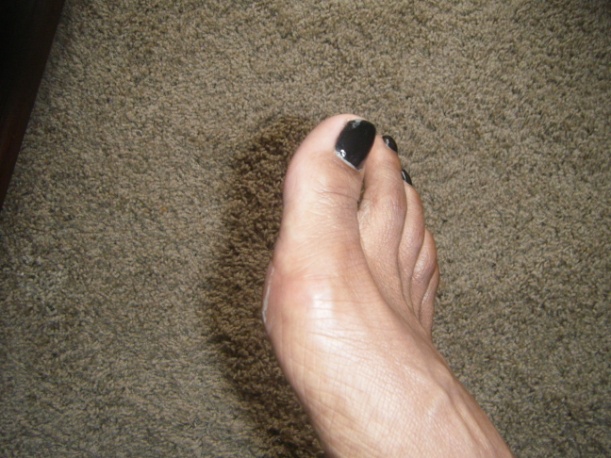 Body Glide for Foot Blisters - Nettye Johnson